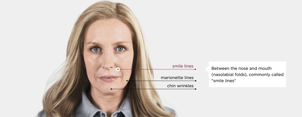 Sculptra - Dermalogic Laser Center - Hammonton, NJ