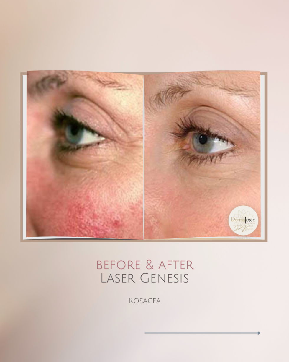 Calm Down Rosacea | Dermalogic Laser Center