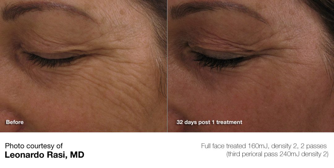 Pearl Fractional | Dermalogic Laser Center