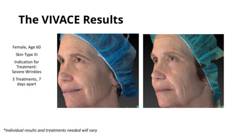 Vivace - Dermalogic Laser Center - Hammonton, NJ